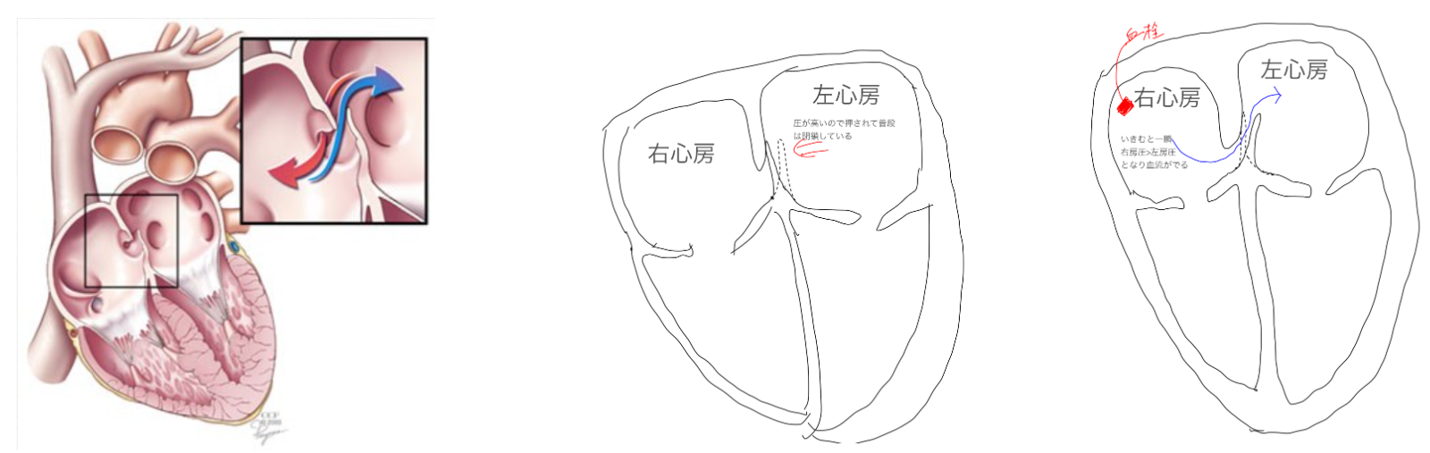 My personal slides – Cryptogenic strokeとESUS